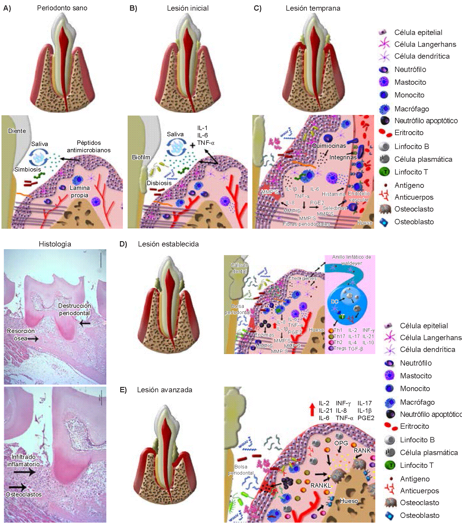Mecanismos inflamatorios en la destrucción periodontal