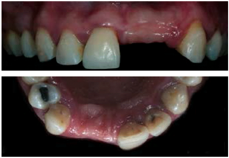 Regeneración ósea de un defecto horizontal en zona estética con lámina ...