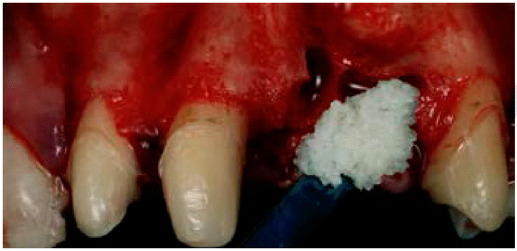 Regeneración ósea de un defecto horizontal en zona estética con lámina ...