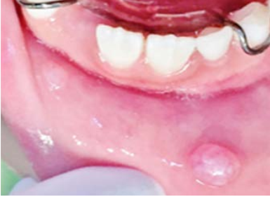 Linfangiectasia adquirida de labio inferior. Reporte de caso