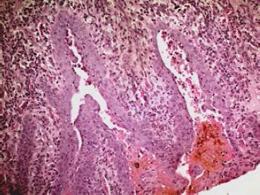 Pemphigus vulgaris: the importance of stomatology findings in early ...