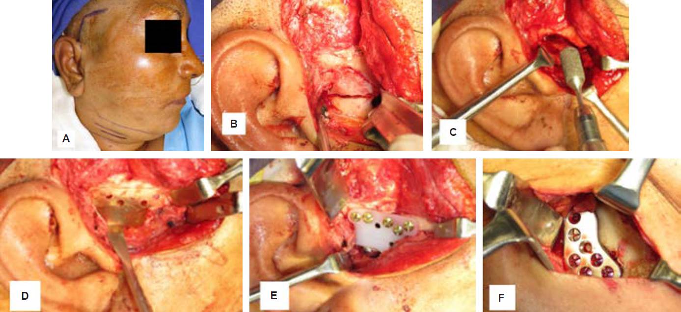 Reemplazo total de articulación temporomandibular en pacientes con ...