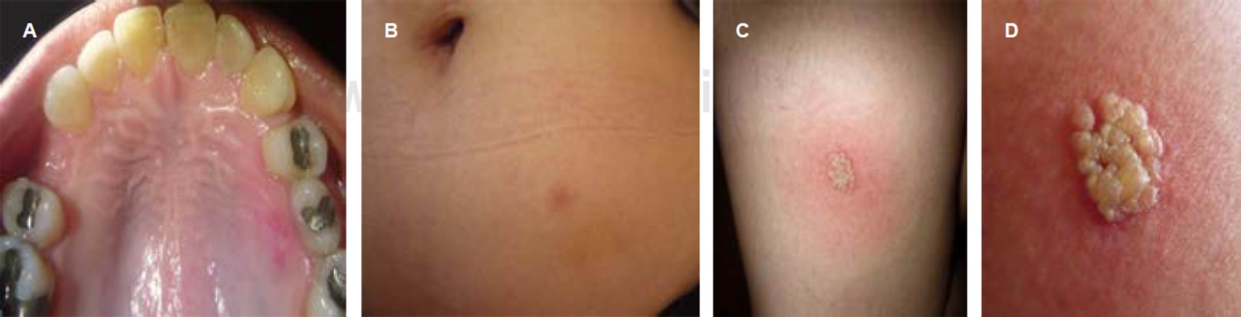 Leukocytoclastic vasculitis due to reactivation of virus varicella ...