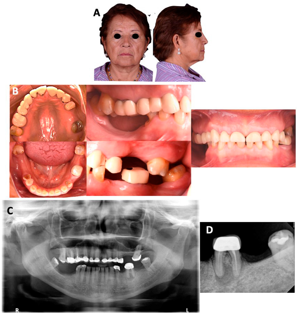 Manejo interdisciplinario de rehabilitación oral en paciente con ...