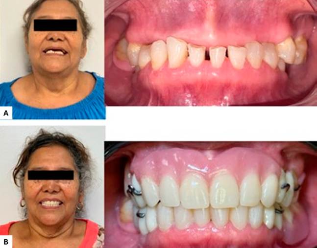 Rehabilitación oral en paciente con disminución de la dimensión ...