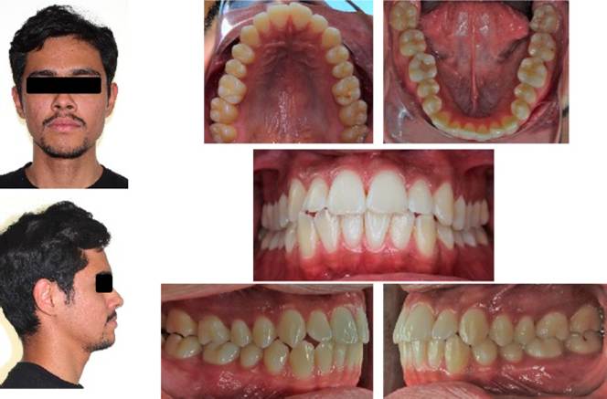 Tratamiento de biprotrusión dentoalveolar mediante distalización con ...