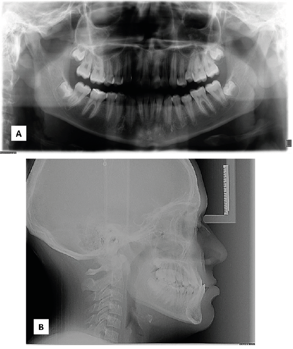 Microosteoperforaciones y uso de máscara facial reversa como ...