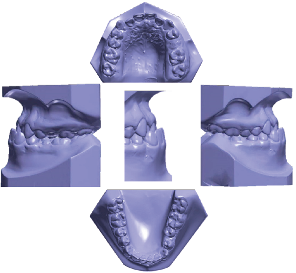 Microosteoperforaciones y uso de máscara facial reversa como ...