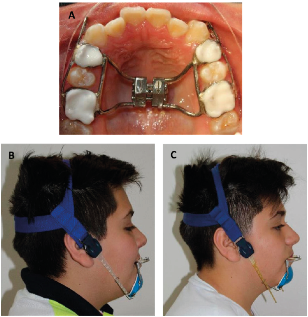 Microosteoperforaciones y uso de máscara facial reversa como ...