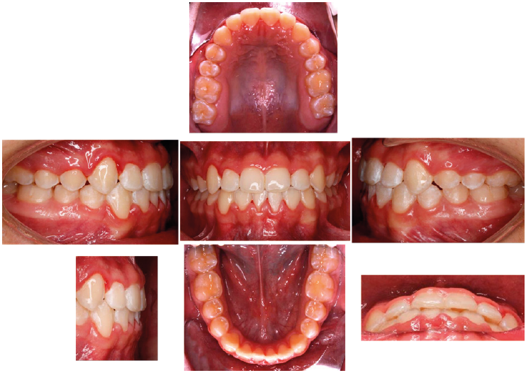 Microosteoperforaciones y uso de máscara facial reversa como ...