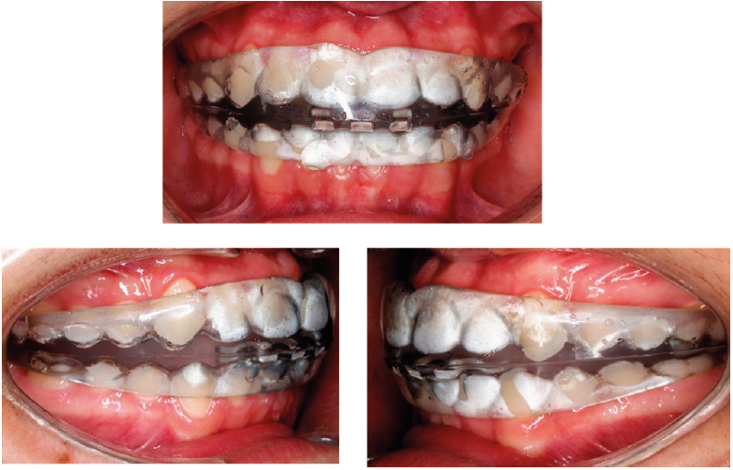Microosteoperforaciones y uso de máscara facial reversa como ...