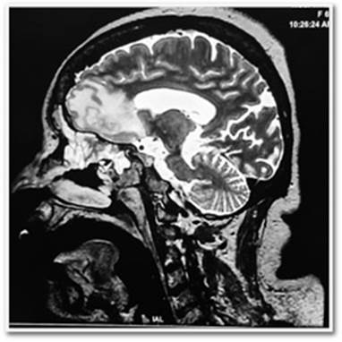 Absceso cerebral: revisión de caso clínico