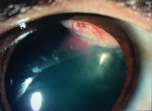 Melanoma del cuerpo ciliar en un adulto joven: reporte de caso