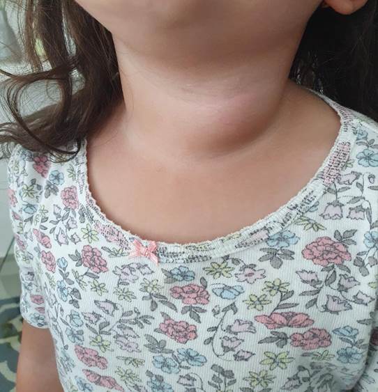 Manejo endoscópico de fístulas del seno piriforme. Reporte de dos casos