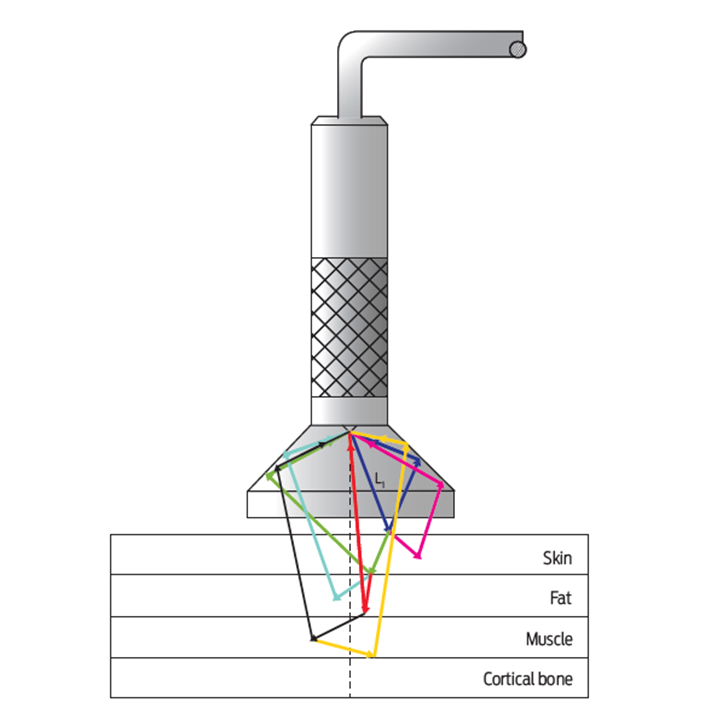 Quantitative evaluation of osteogenesis through infrared light. Pilot study
